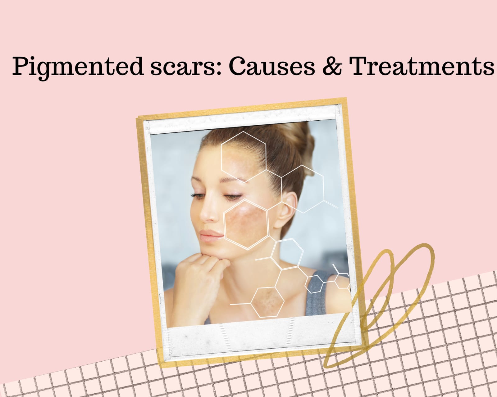Pigmented scars: Causes & Treatments - Dr. Rashmi Shetty